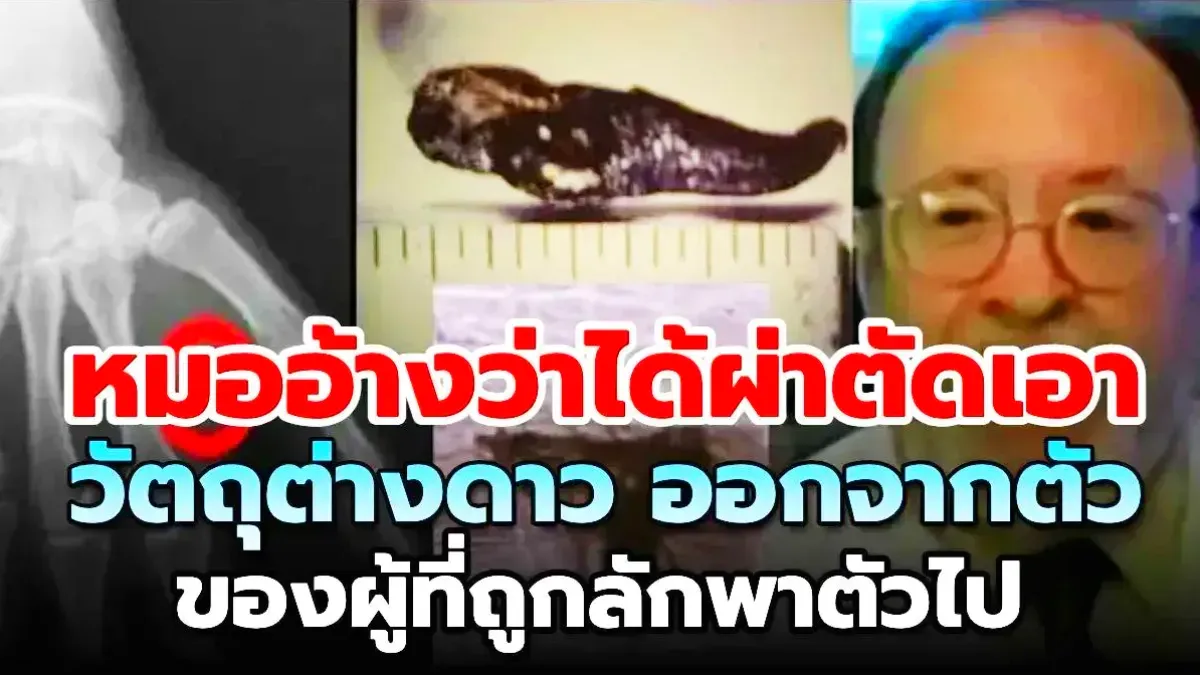 แพทย์อ้างว่าได้ผ่าตัดเอา วัตถุต่างดาว ออกจากตัวของผู้ที่ถูกลักพาตัวไป