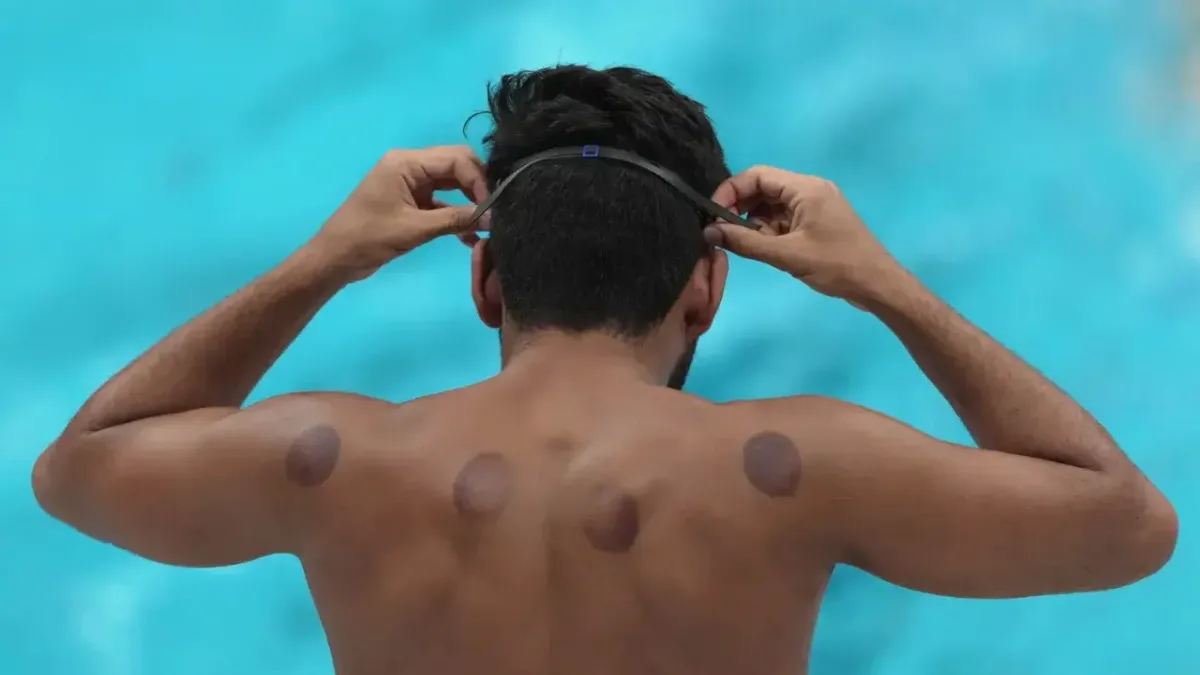 การครอบแก้ว (Cupping Therapy) เป็นอีกหนึ่งทางเลือกในการบำบัดความเจ็บปวด ...